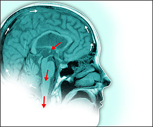 A disorder easily missed | News Archive News - The Indian Express