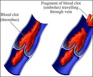 Superficial blood clots may be warning sign: Study | Health News - The ...