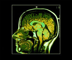 Injectable gel helps regenerate brain tissue in traumatic injuries ...