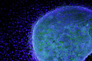 Indian-origin scientist makes breakthrough in cancer research | Health ...
