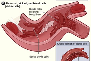 Pre-marital and pre-natal tests could help prevent sickle cell: Expert ...