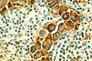 Using sound waves to kill cancer? | Health News - The Indian Express