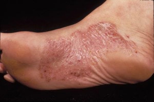 Psoriasis tied to higher risk of diabetes | Health News - The Indian ...