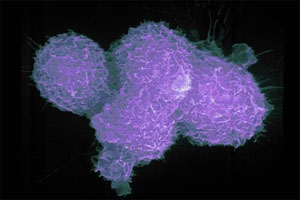 Male prostate cancer has two viruses linked to human cancer | Health ...