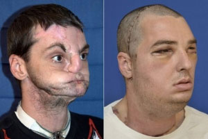 US man gets new face after world’s most extensive transplant | Health ...