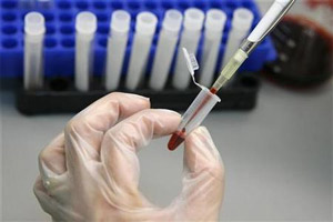 Rapid HIV treatment points to ‘functional cure’ for AIDS | Health News ...