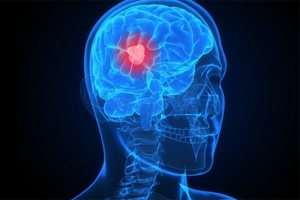 Researchers find new way to combat brain cancer | Health News - The ...
