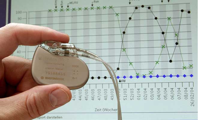 New ‘pacemaker’ device could treat sleep apnea | Technology News - The ...
