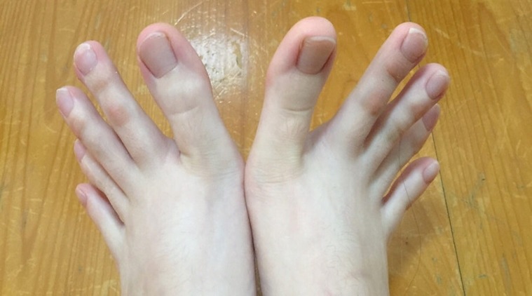 Internet’s going crazy over this girl who has toes as long as fingers ...