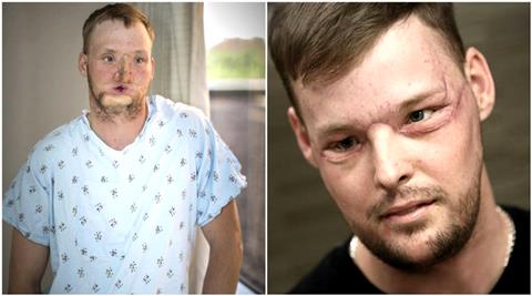 50-hour face transplant recovers US man’s wounded face after 10 years ...
