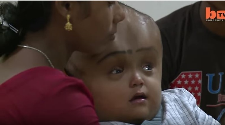 Tripura girl with giant head syndrome tragically dies before corrective ...