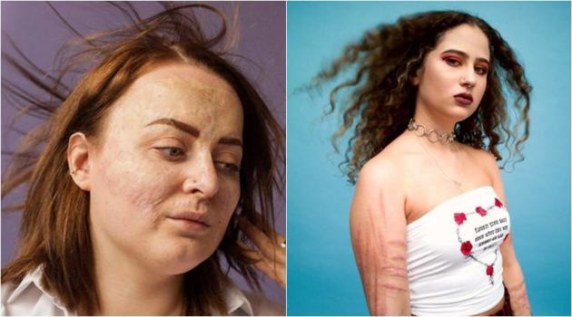 Embrace your scars and flaunt them, for they too have a story ...