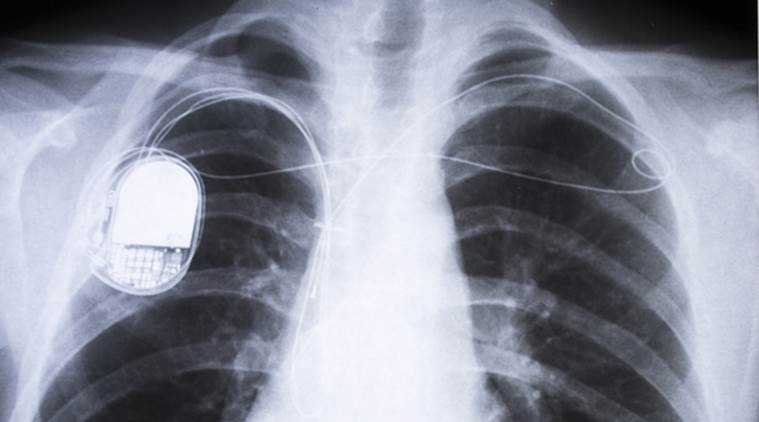 Novel pacemakers can be powered with light | Technology News - The ...