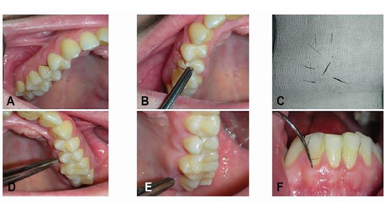 Italian woman with rare condition has hair growing out of her gums ...