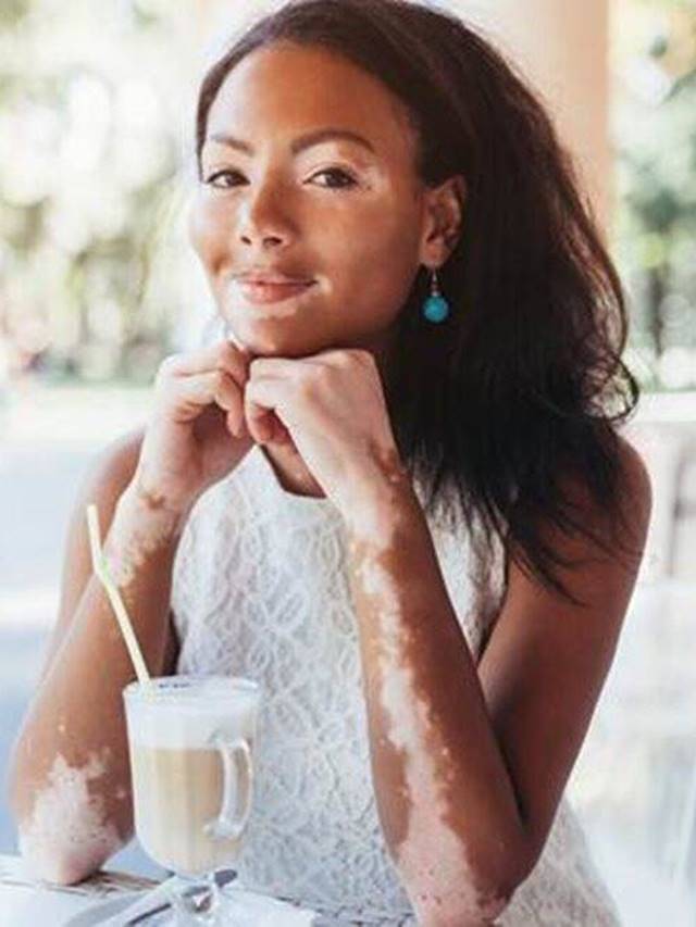 Here’s how you can manage vitiligo | The Indian Express