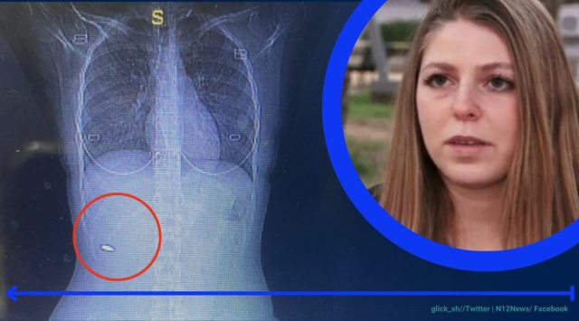 Woman finds bullet lodged near spine 3 months after being shot, thought ...