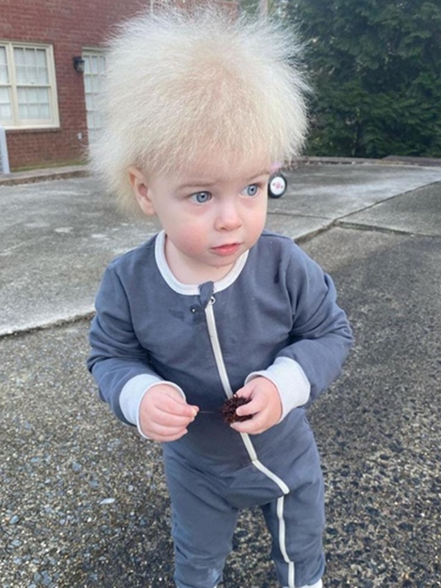 Uncombable hair syndrome: A rare genetic condition | The Indian Express