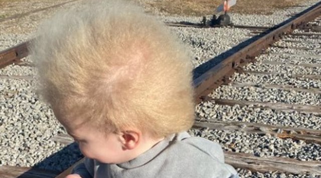 Toddler diagnosed with ‘uncombable hair syndrome’: Know all about the ...