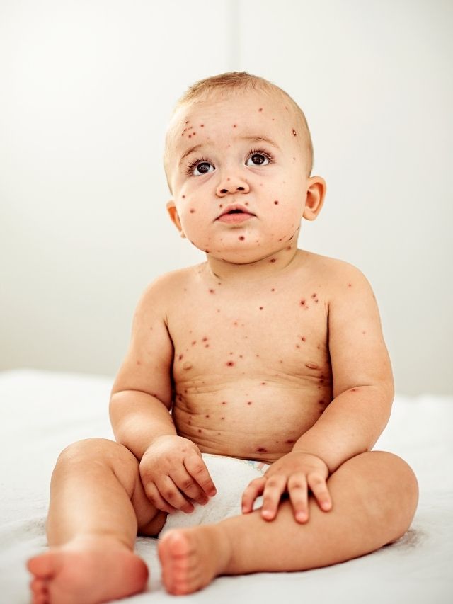 Monkeypox detected in UK; all you need to know about its transmission ...