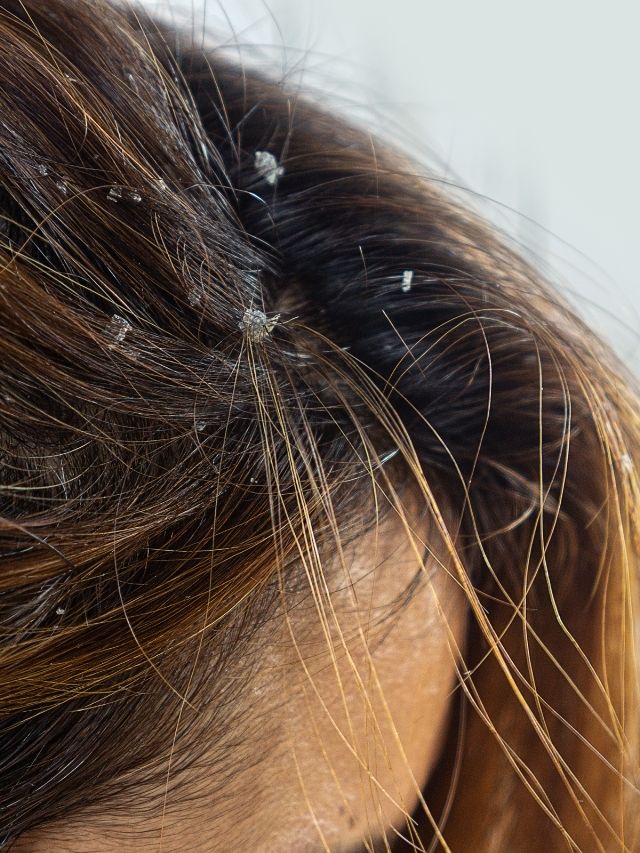 Say-goodbye-to-oily-greasy-scalp-with-these-expert-tips.jpeg