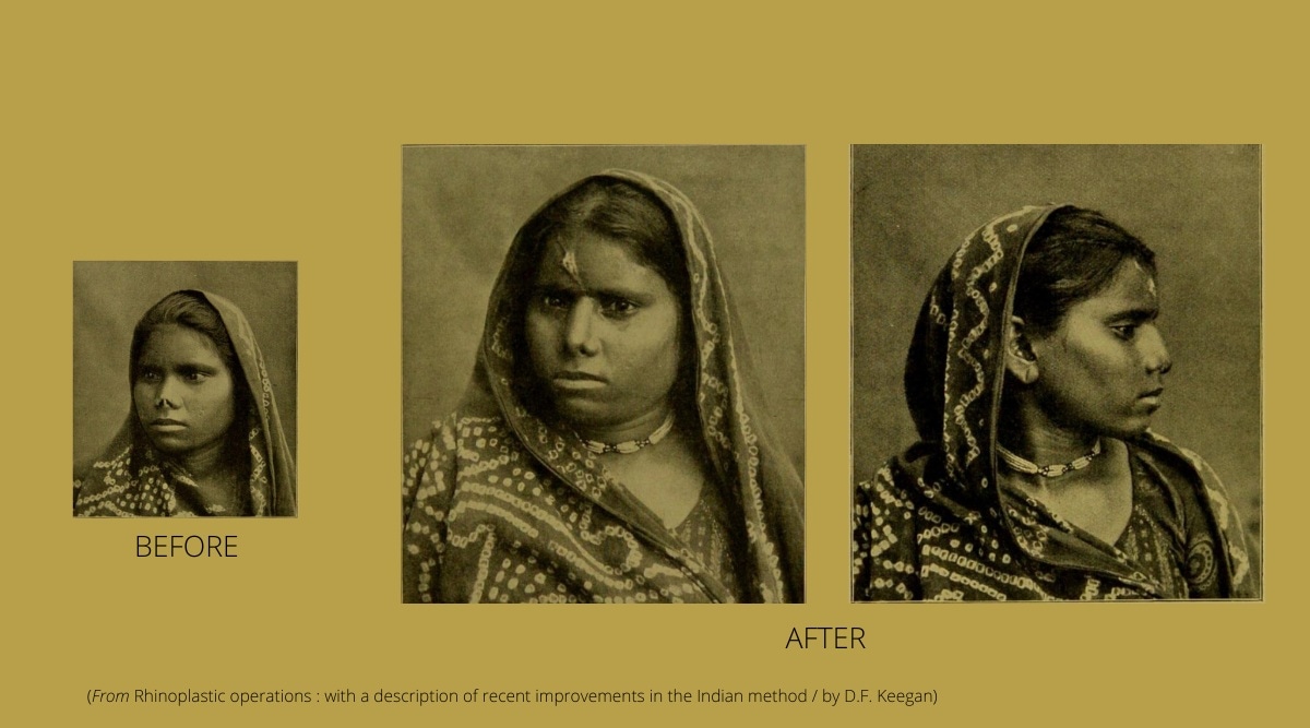 Know Your City: How a rhinoplasty in Pune back in 1793 became a model ...