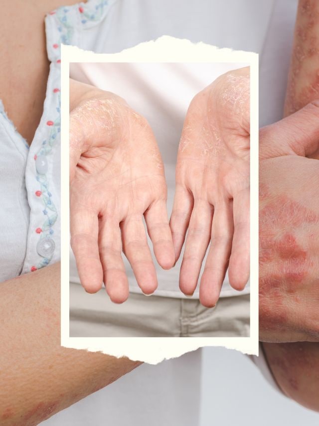 What causes psoriasis? | The Indian Express