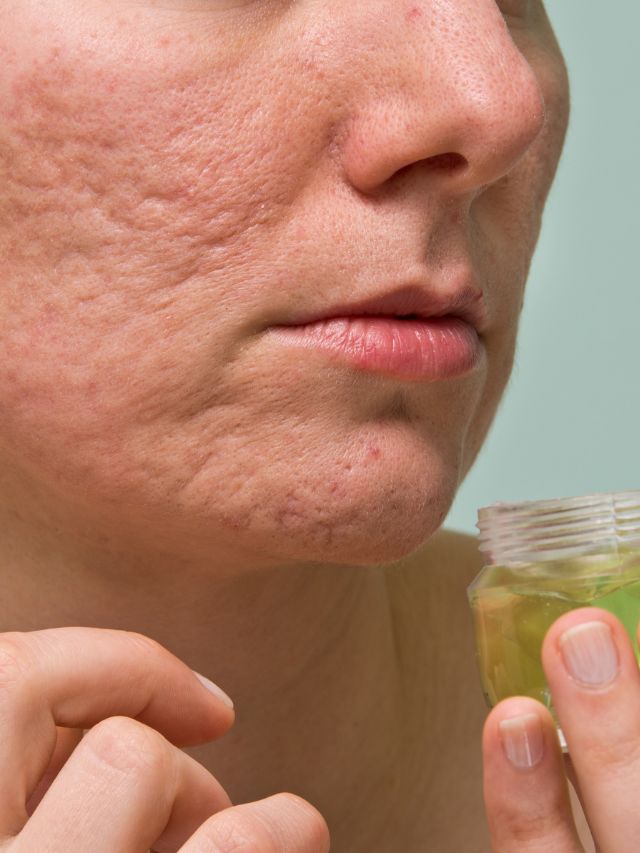 Why you shouldn’t burst your acne | The Indian Express