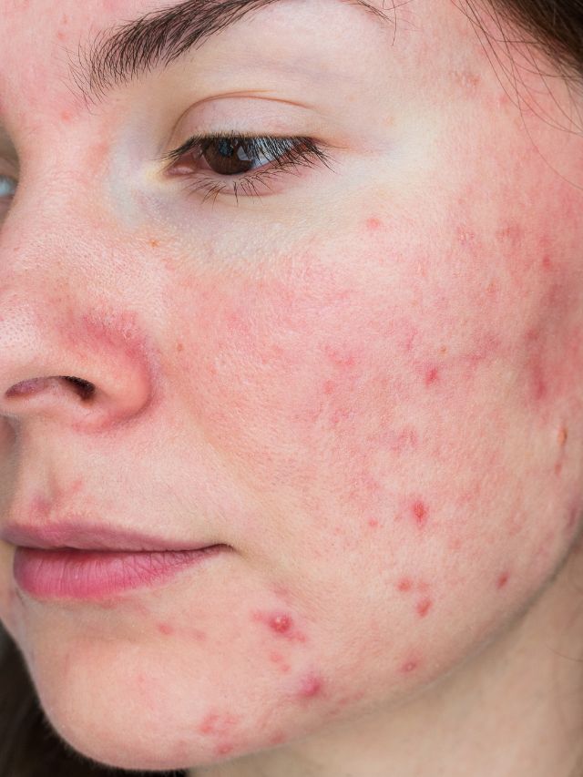 Symtpoms of Rosacea | The Indian Express