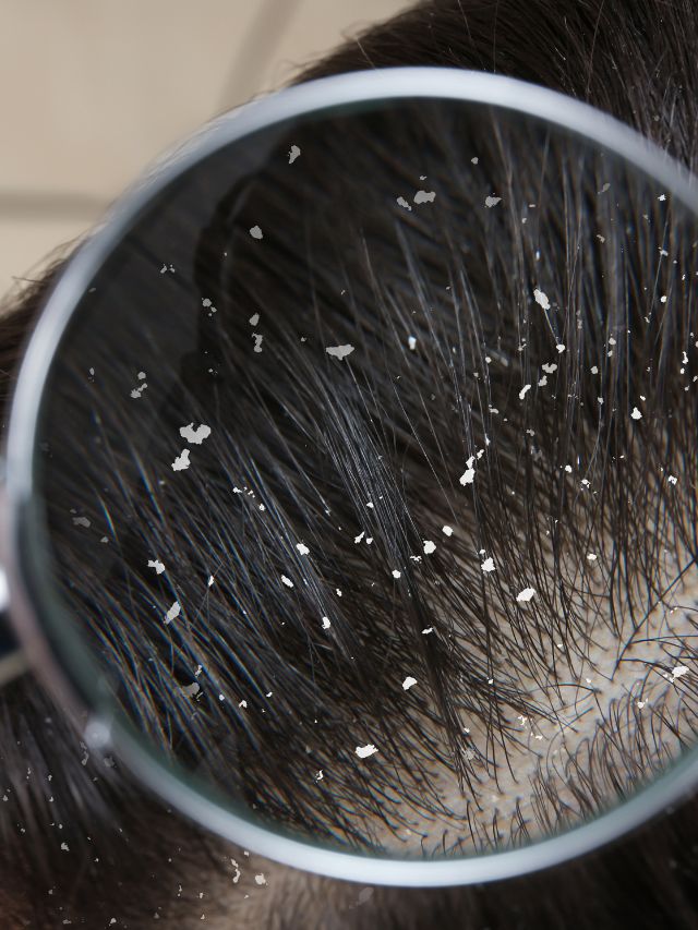 Tips to deal with dandruff | The Indian Express