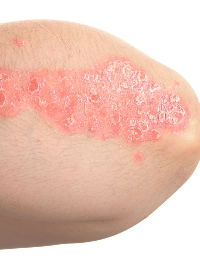 psoriasis.jpg
