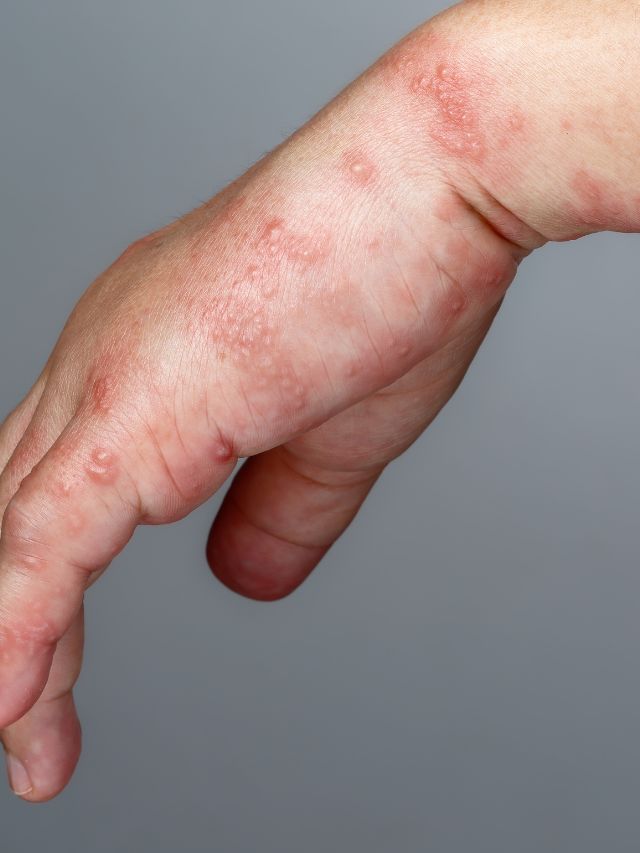 Minimise, reverse and prevent skin inflammation with these tips | The ...