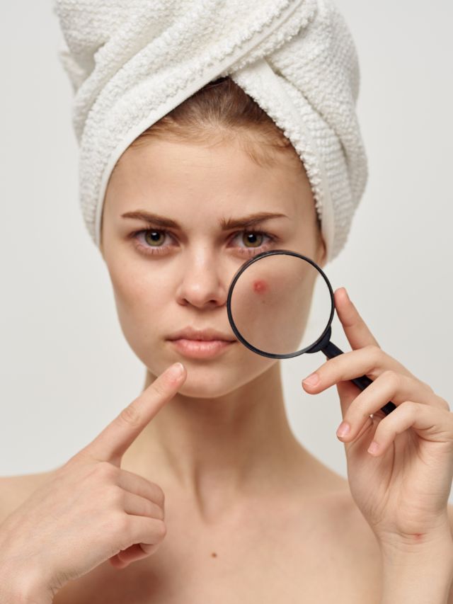 How To Avoid Adult Acne The Indian Express