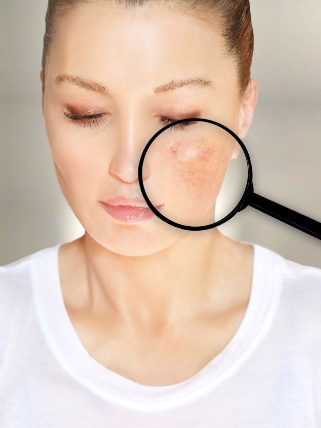 rosacea.jpg