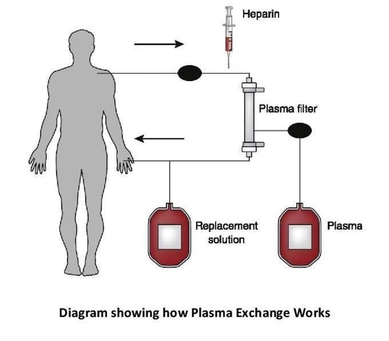 Plasma exchange at Rs 30,000 saves patient with acute liver failure who ...