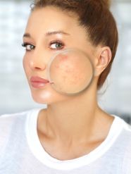 Skin Conditions That Look Like Acne The Indian Express Skin Conditions That Look Like Acne The Indian Express