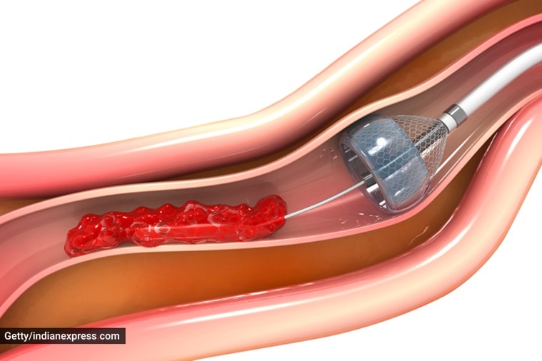 How soon can you go back to exercising after experiencing a cardiac event?