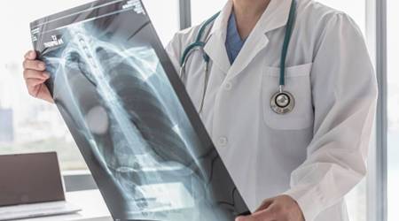 Tuberculosis: News, Photos, Latest News Headlines about Tuberculosis ...