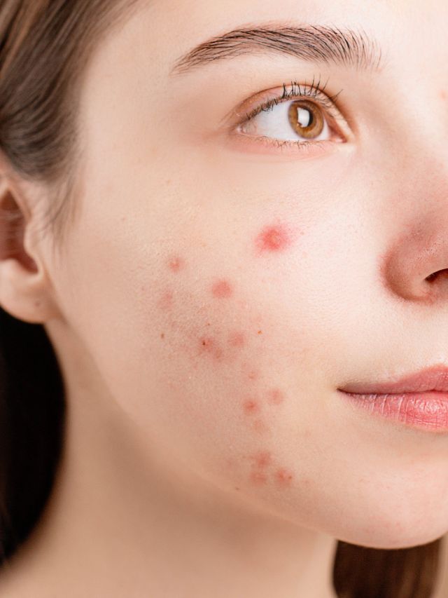 Why people with acne must consume a low-glycemic index diet | The ...