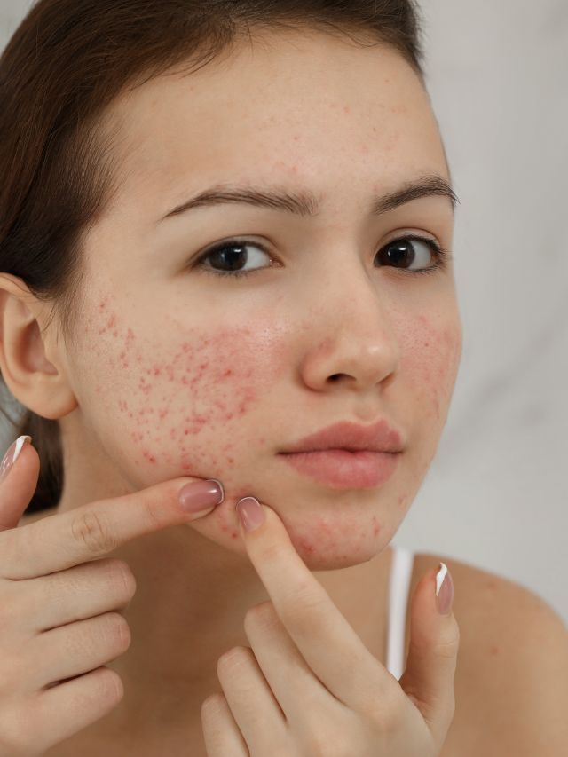 Expert shares common reasons behind your acne | The Indian Express