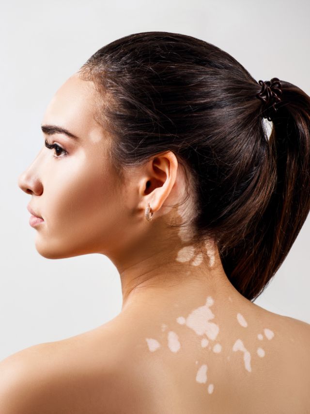 What is vitiligo? | The Indian Express