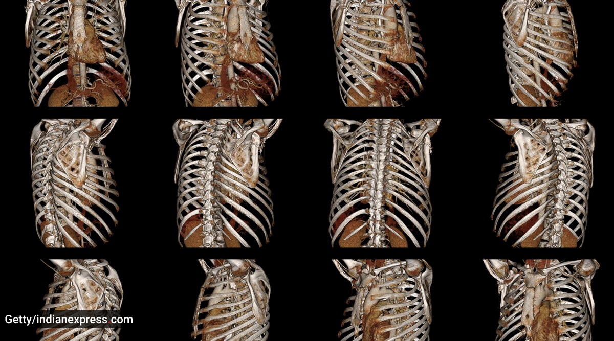 There’s no evidence that CT angio prevents sudden heart attacks and ...
