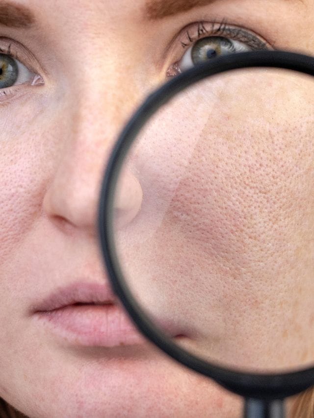 Why You May Have Enlarged Pores The Indian Express