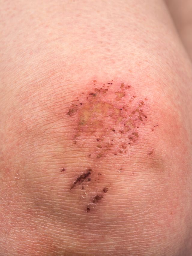 When do we need to see an expert about a random bruise? | The Indian ...