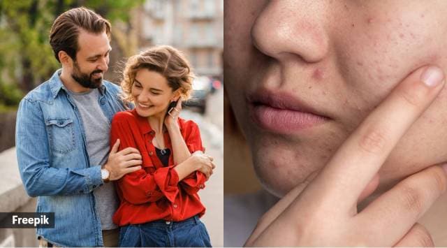 Can your partner’s beard give you acne? | Health News - The Indian Express