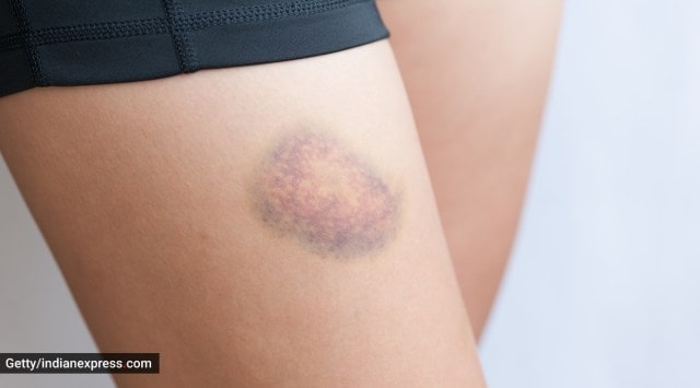 What Causes Unexplained Bruising On The Body Health News The Indian Express