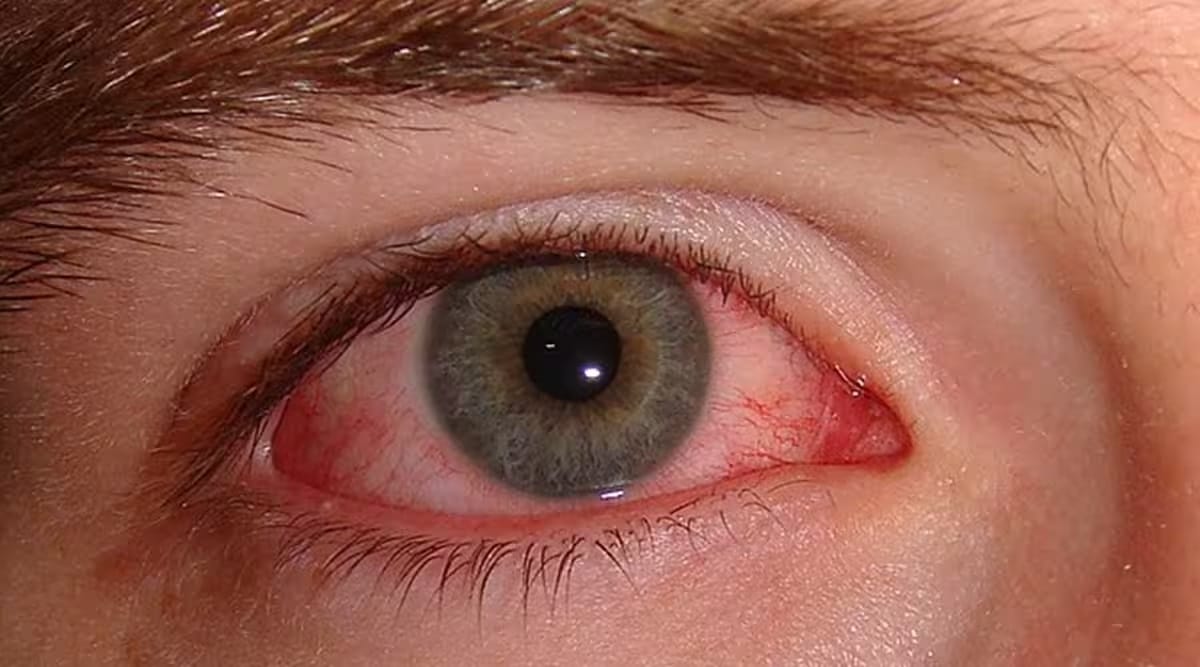 Conjunctivitis: How to protect yourself from pink eye in crowded places ...