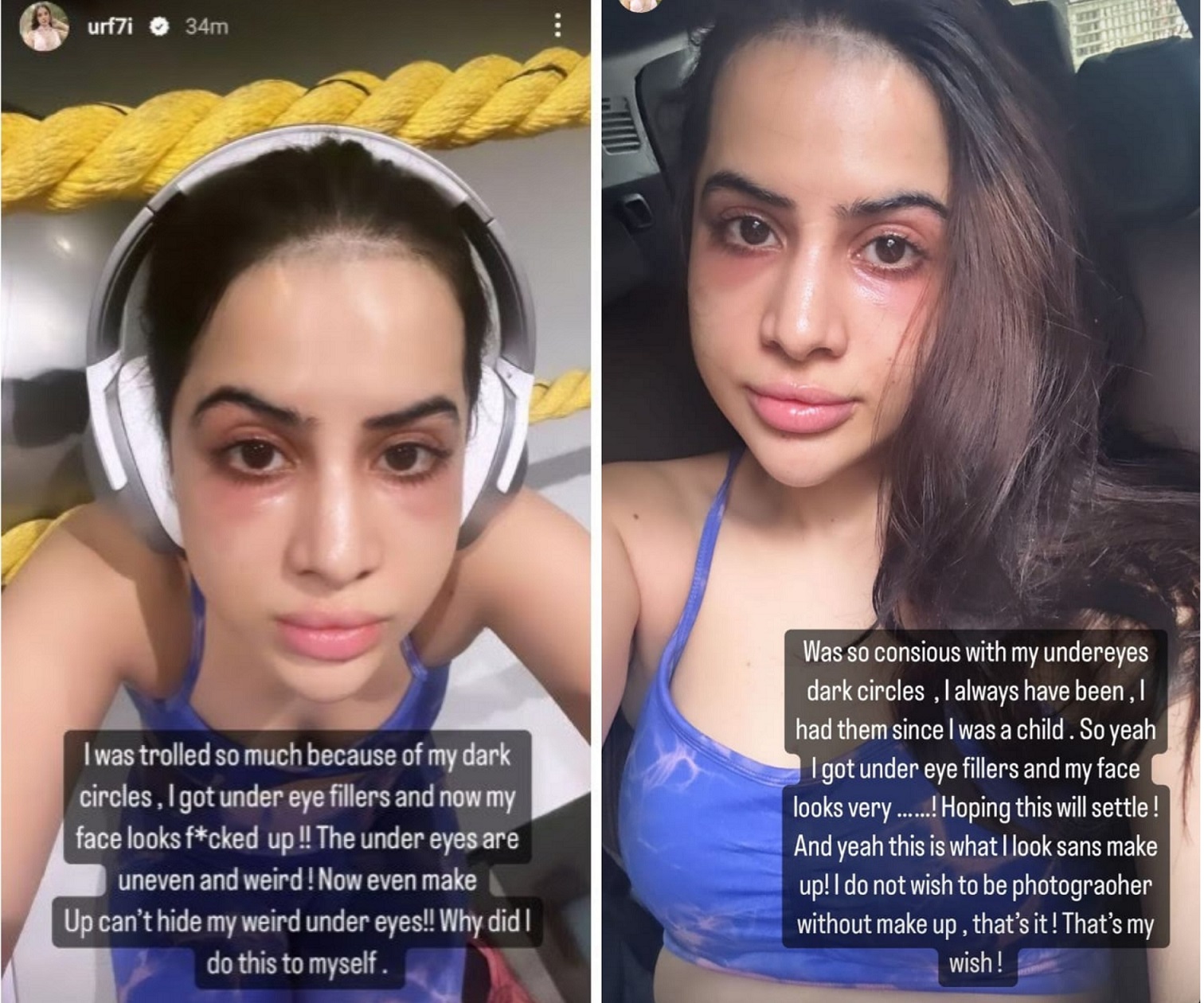 Uorfi Javed gets under-eye fillers after being trolled, laments over ...