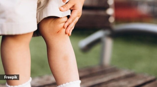 How does arthritis affect children | Life-style News - The Indian Express