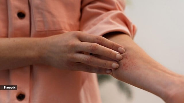 5 most common skin rashes and how to deal with them | Life-style News ...