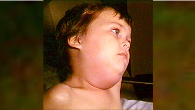 Mumps outbreak: In males, it can lead to swelling of testis, infertility